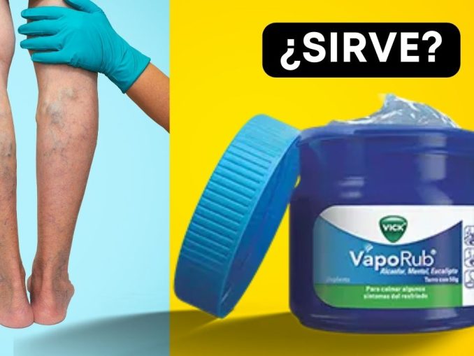 Cremas para varices [Guía 2023] - Las mejores y más efectivas